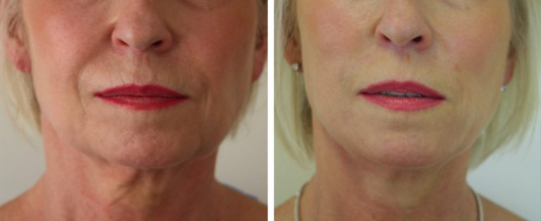 Spring Thread Lift | Surgical Thread Lifting | Aesthetic Clinics