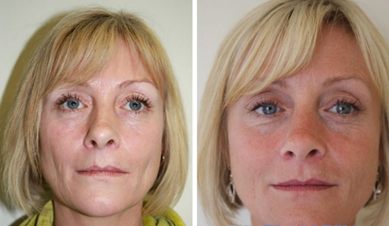 Sculptra & Lanluma Filler | Sculptra Filler | Aesthetic Clinics