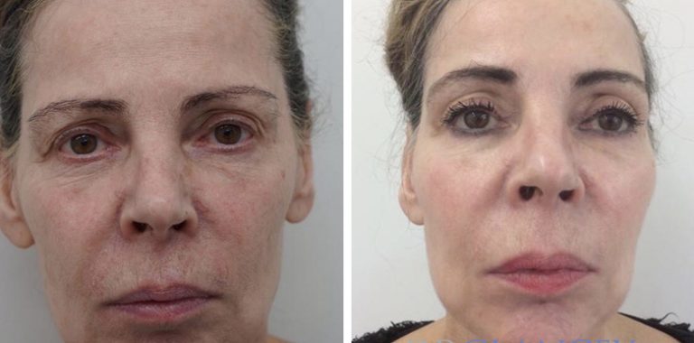 Spring Thread Lift | Surgical Thread Lifting | Aesthetic Clinics